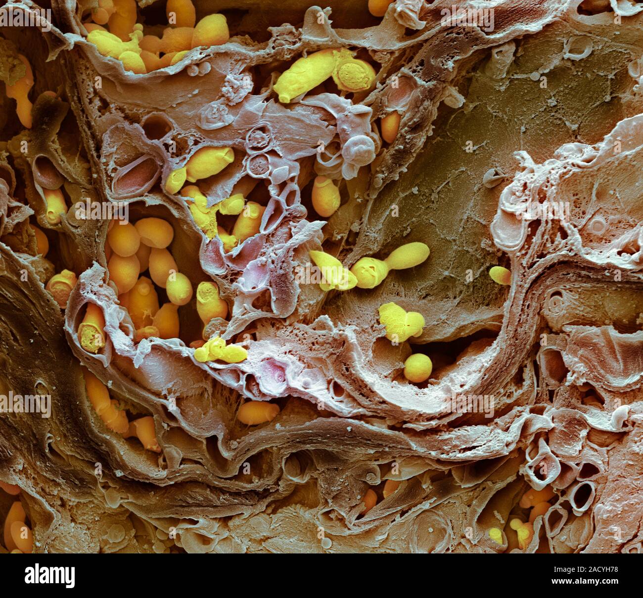 Thrush infection of the tongue. Coloured scanning electron micrograph ...