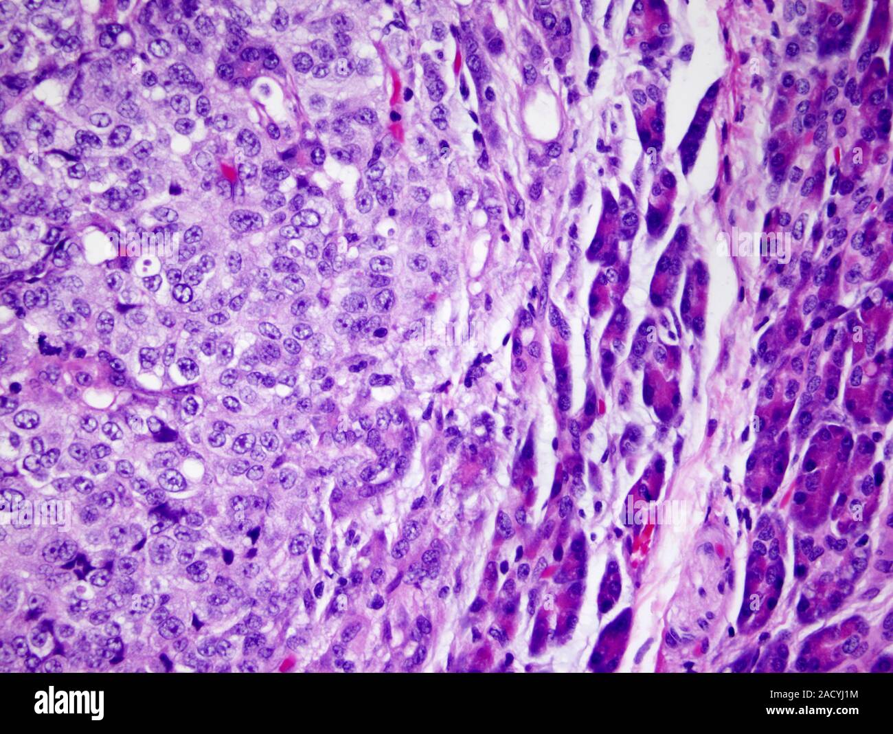 Secondary pancreatic cancer. Light micrograph of a section through ...