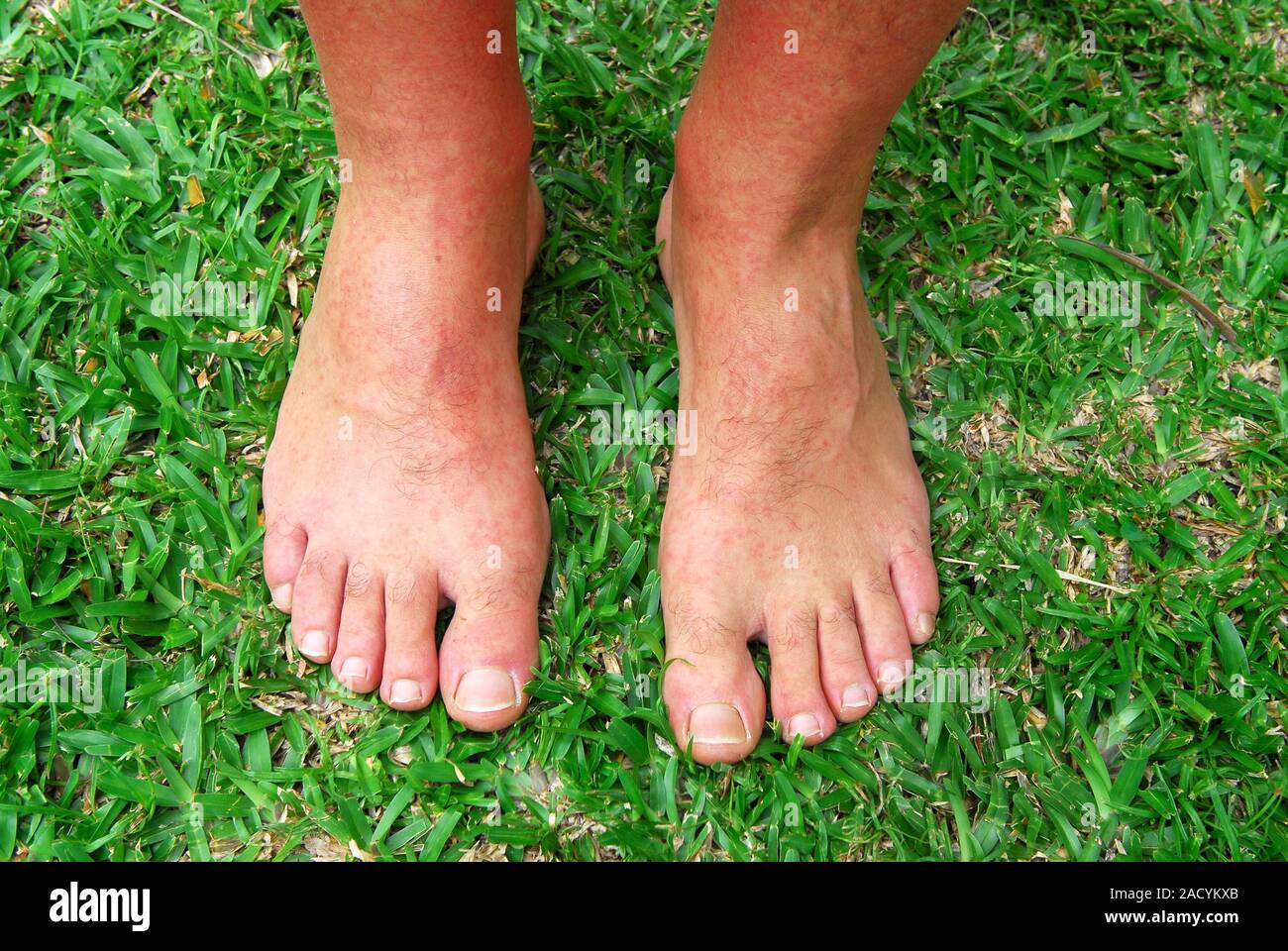 Chikungunya patient's feet. This disease, caused by the Chikungunya ...