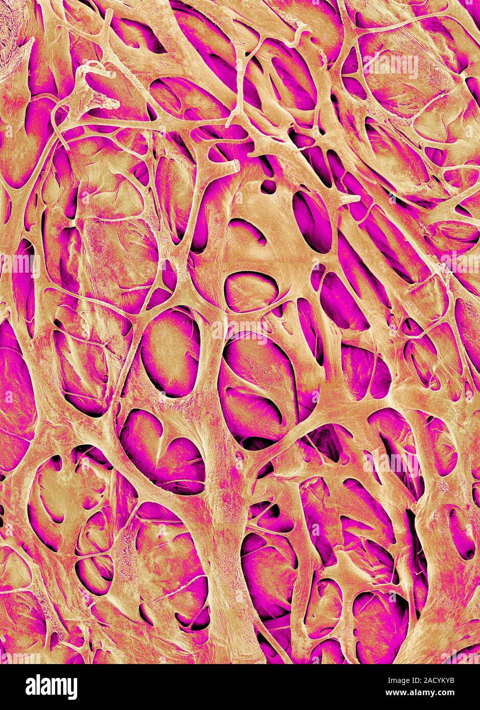 Trabeculae carneae in the right ventricle of the heart, coloured ...