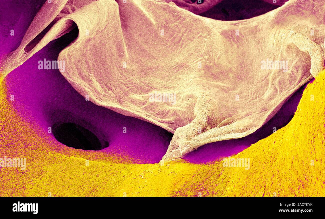 Aortic valve (top), coloured scanning electron micrograph (SEM). The ...