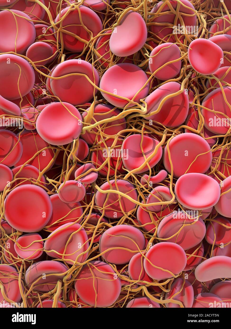 Blood clot, illustration. Red blood cells (erythrocytes) are trapped ...
