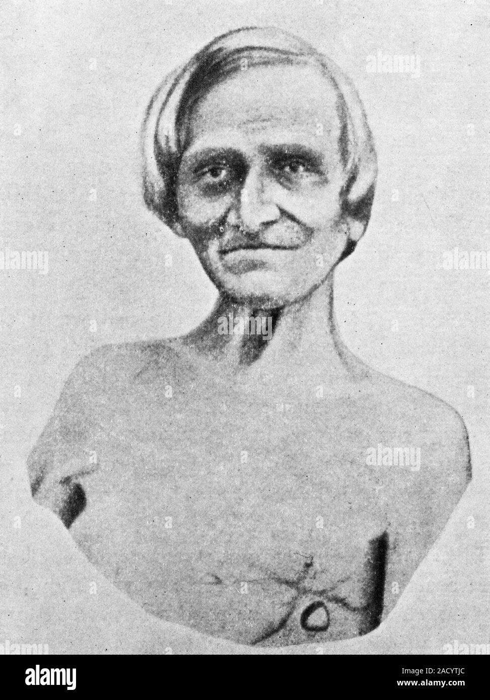 Stomach digestion research. 19th-century illustration of Canadian ...