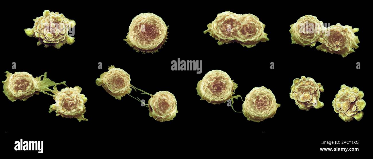 Dividing colorectal cancer cells. Coloured scanning electron micrograph ...