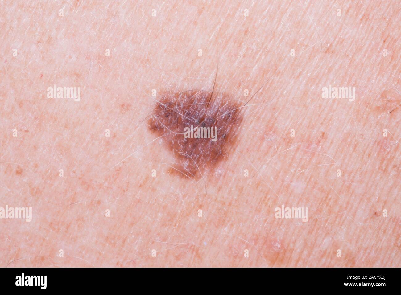 Mole. Close-up of a mole, compound melanocytic naevus, on the arm of a 51-year-old, female ...
