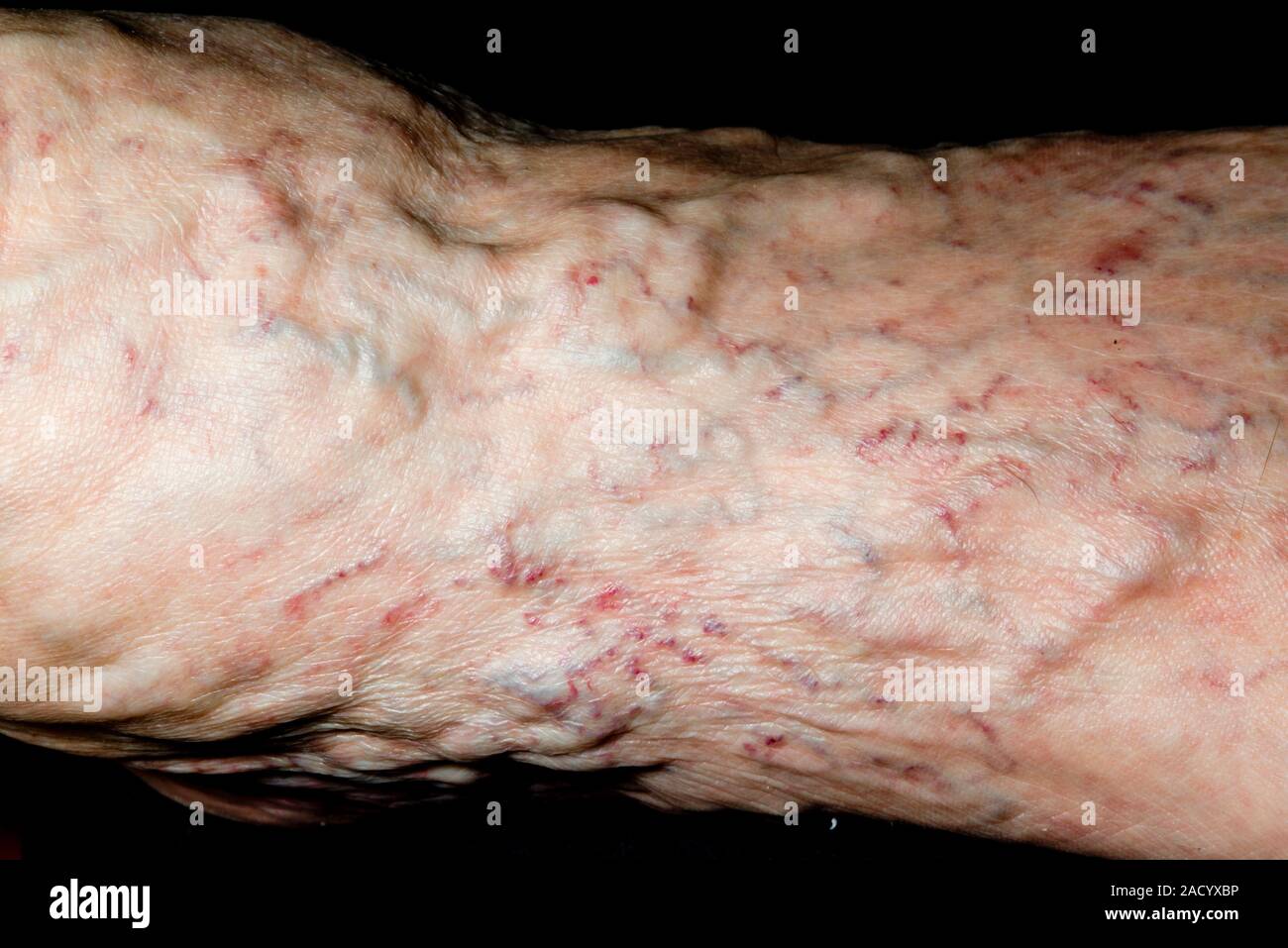 Varicose veins. Close-up of varicose veins on the leg of a 65-year-old ...