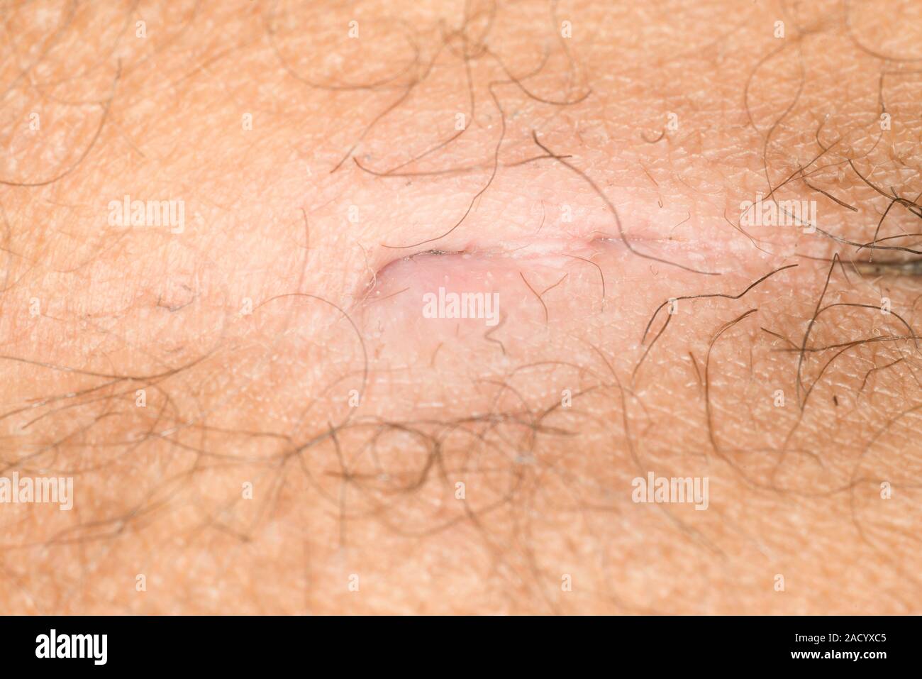 Pilonidal sinus. Close-up of a pilonidal cyst in the cleft between the ...