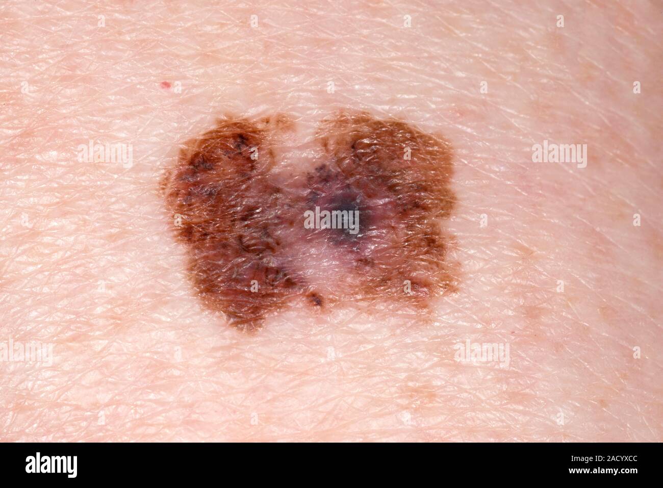 Skin cancer. Close-up of a malignant melanoma (skin cancer) on the ...