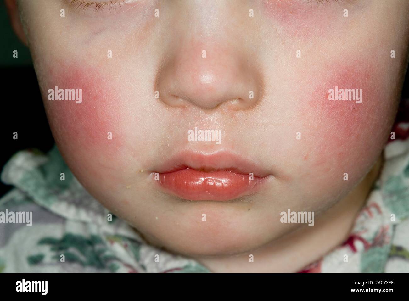 Face in fifth disease. Close-up of the reddened face of a 2-year-old ...