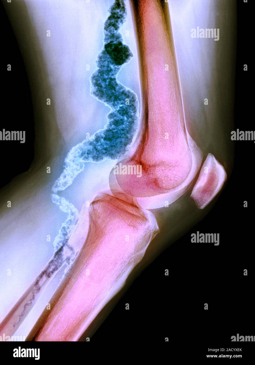 Knee in ACDC. Coloured X-ray of the knee of a patient with ACDC ...