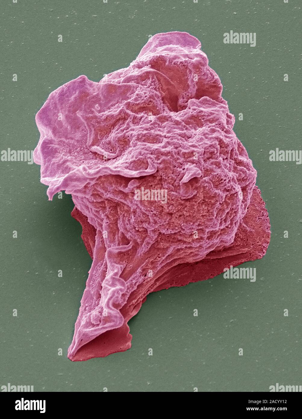Lymphoma cancer cell. Coloured scanning electron micrograph (SEM) of a ...