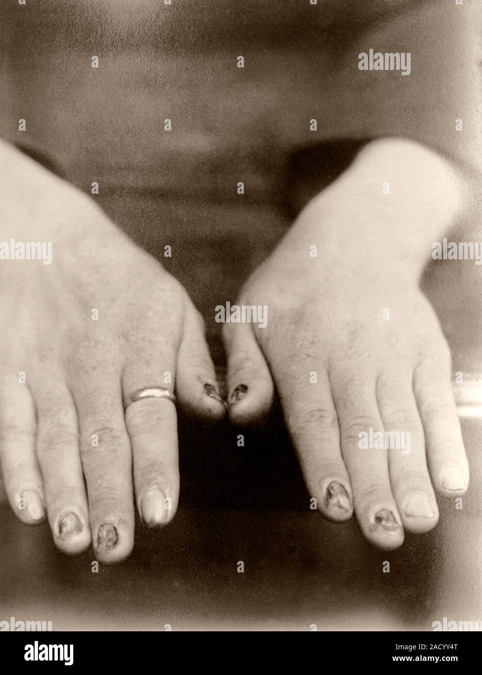 Hands of a woman who has lost fingernails to syphilis. Syphilis is a ...
