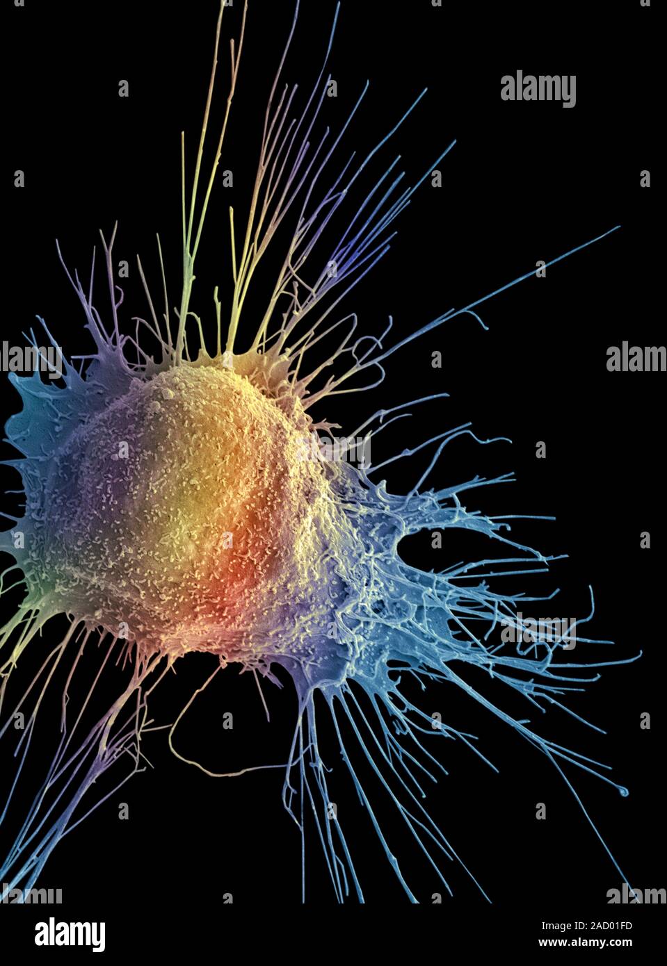 Prostate cancer cell, Coloured scanning electron micrograph (SEM). Such ...