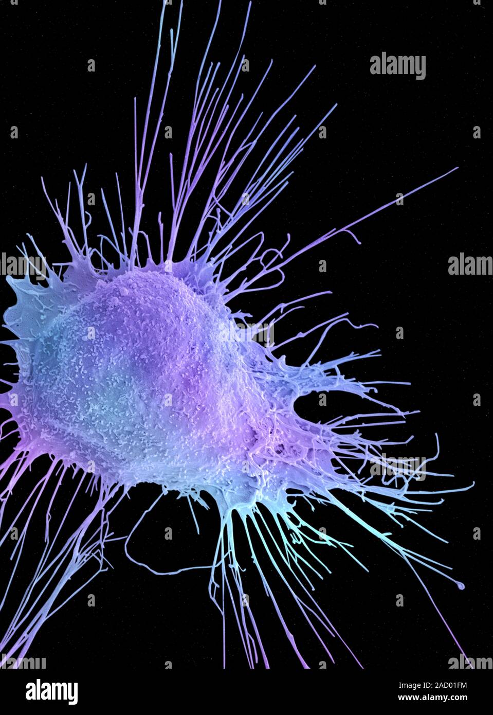 Prostate cancer cell, Coloured scanning electron micrograph (SEM). Such ...
