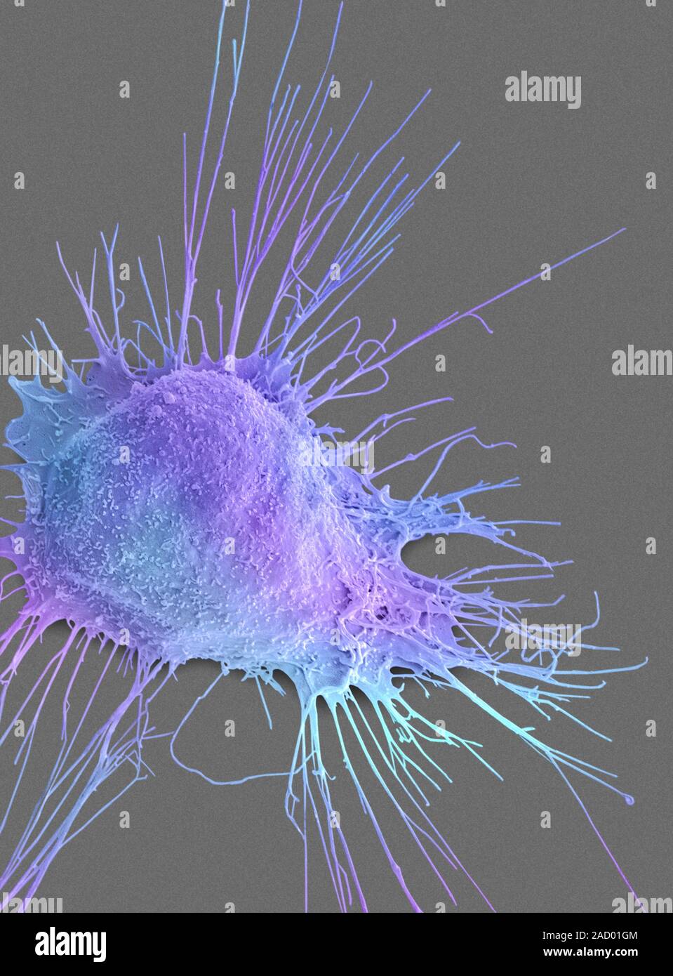 Prostate cancer cell, Coloured scanning electron micrograph (SEM). Such ...