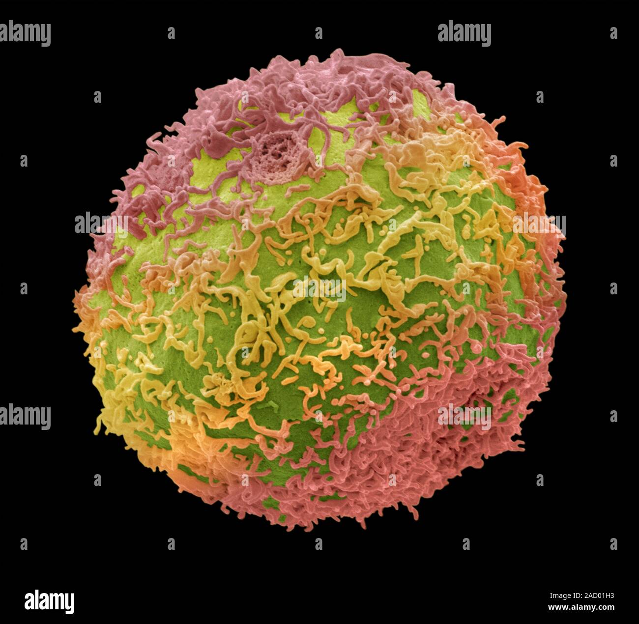 Prostate cancer cell, Coloured scanning electron micrograph (SEM). Such ...