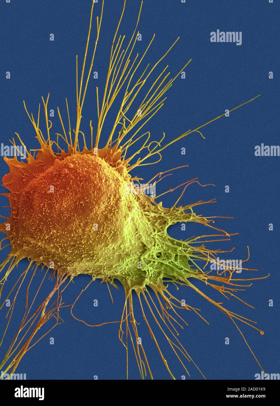 Prostate cancer cell, Coloured scanning electron micrograph (SEM). Such ...