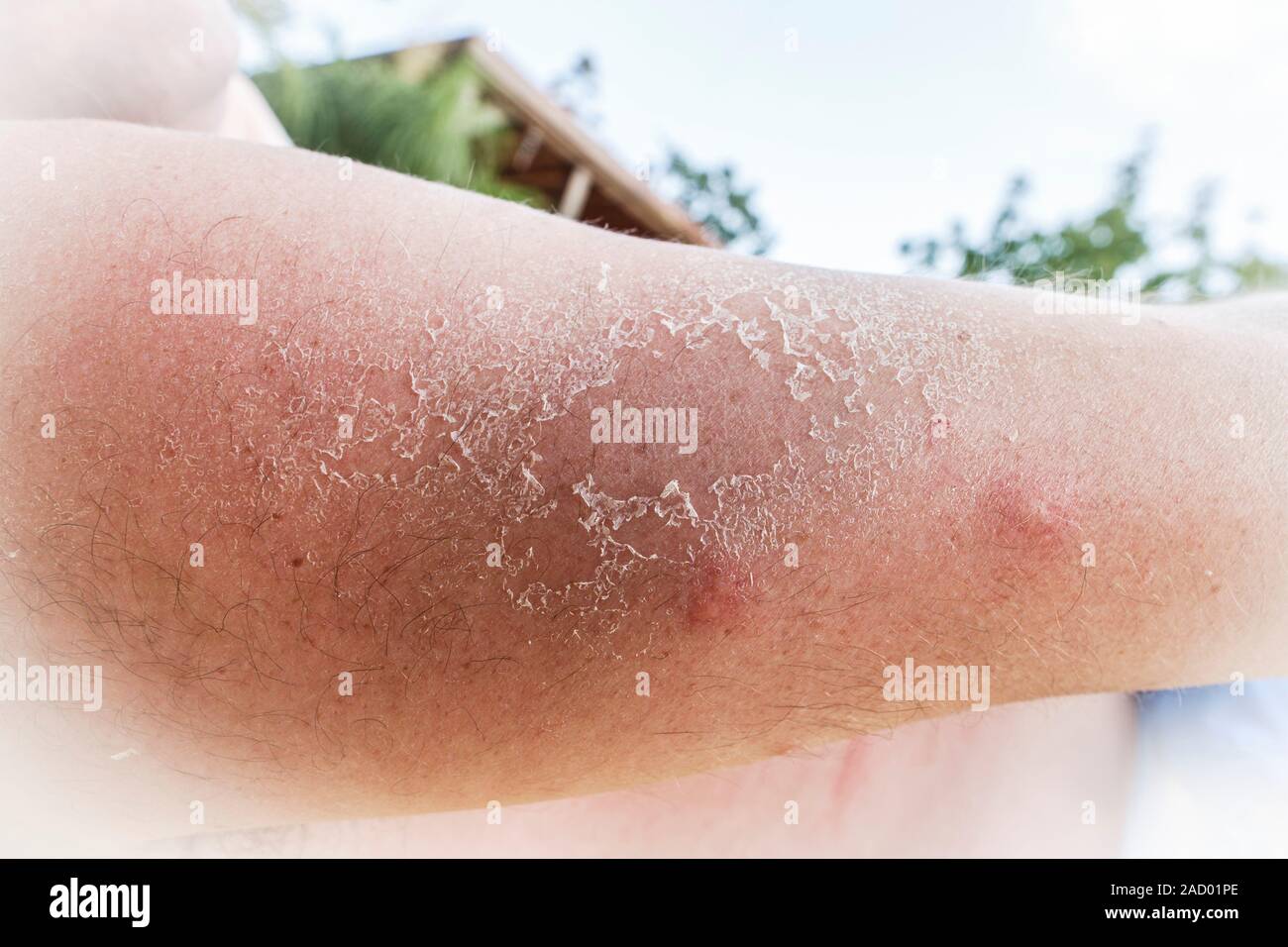 Peeling skin on a man's arm due to sun burn. A couple of mosquito bites ...