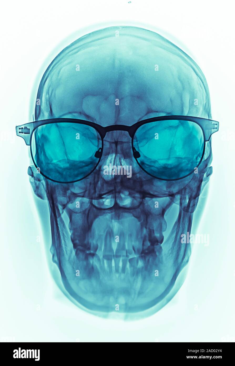 Skull with glasses, coloured X-ray Stock Photo - Alamy