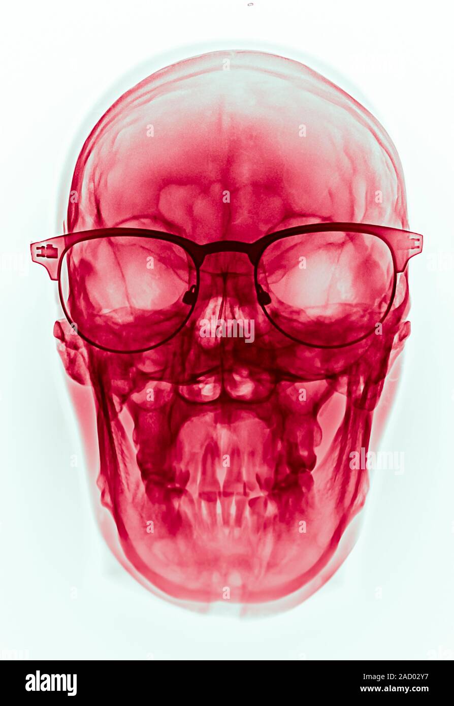 Skull with glasses, coloured X-ray Stock Photo - Alamy