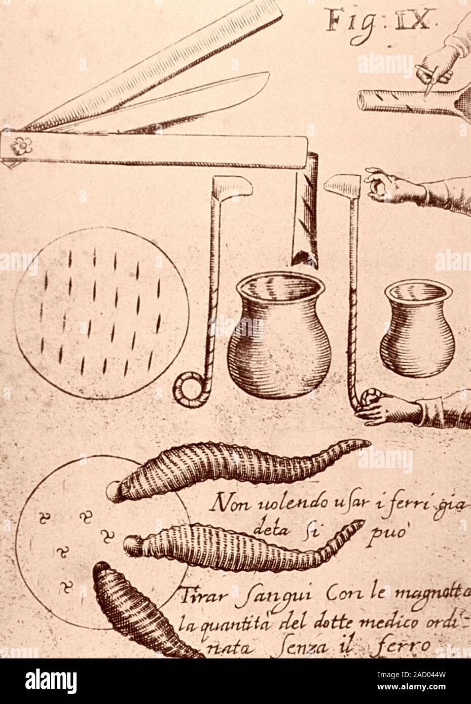Blood-letting instruments. 17th-century illustration of instruments ...