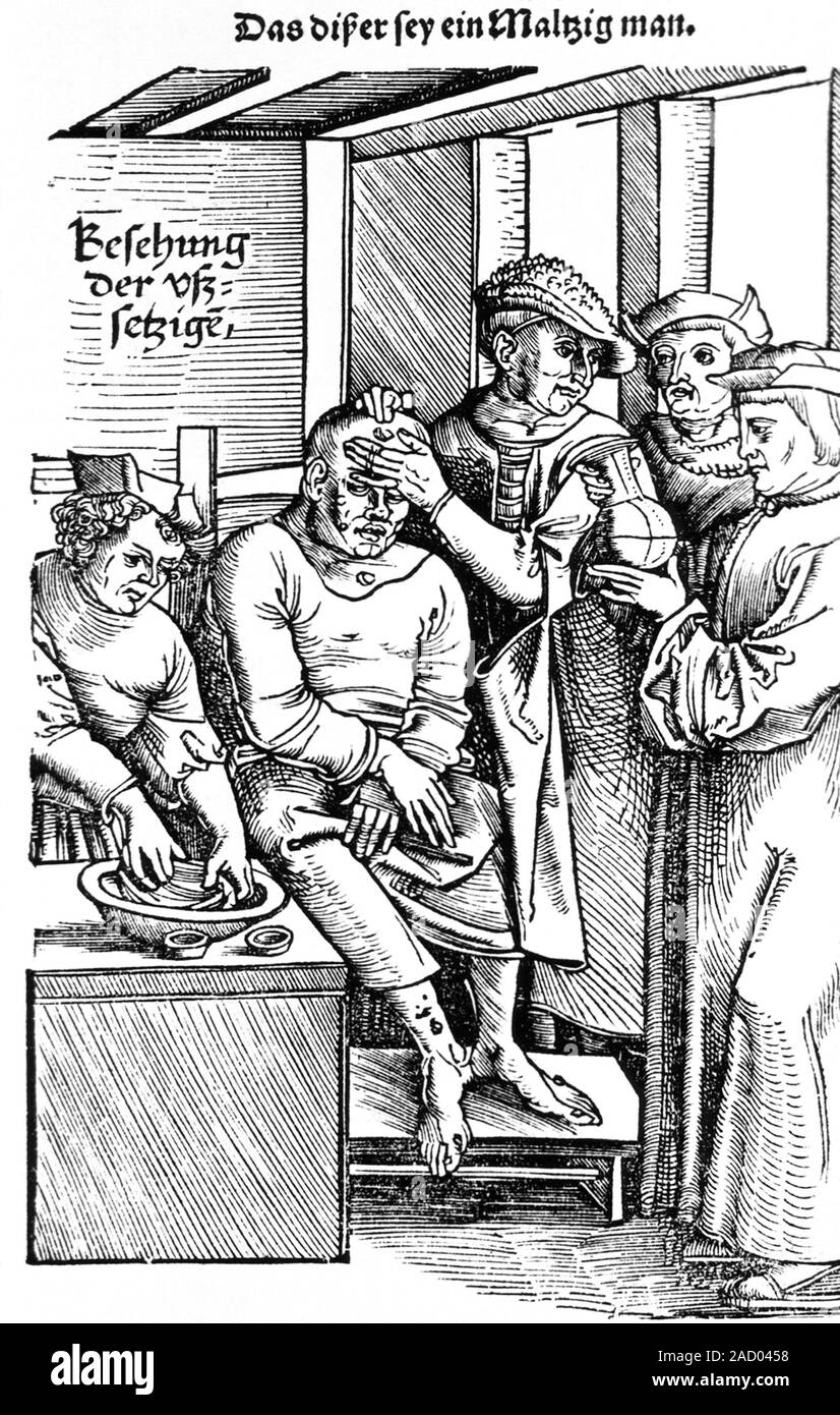 Leprosy diagnosis. 16th-century illustration of physicians examining ...