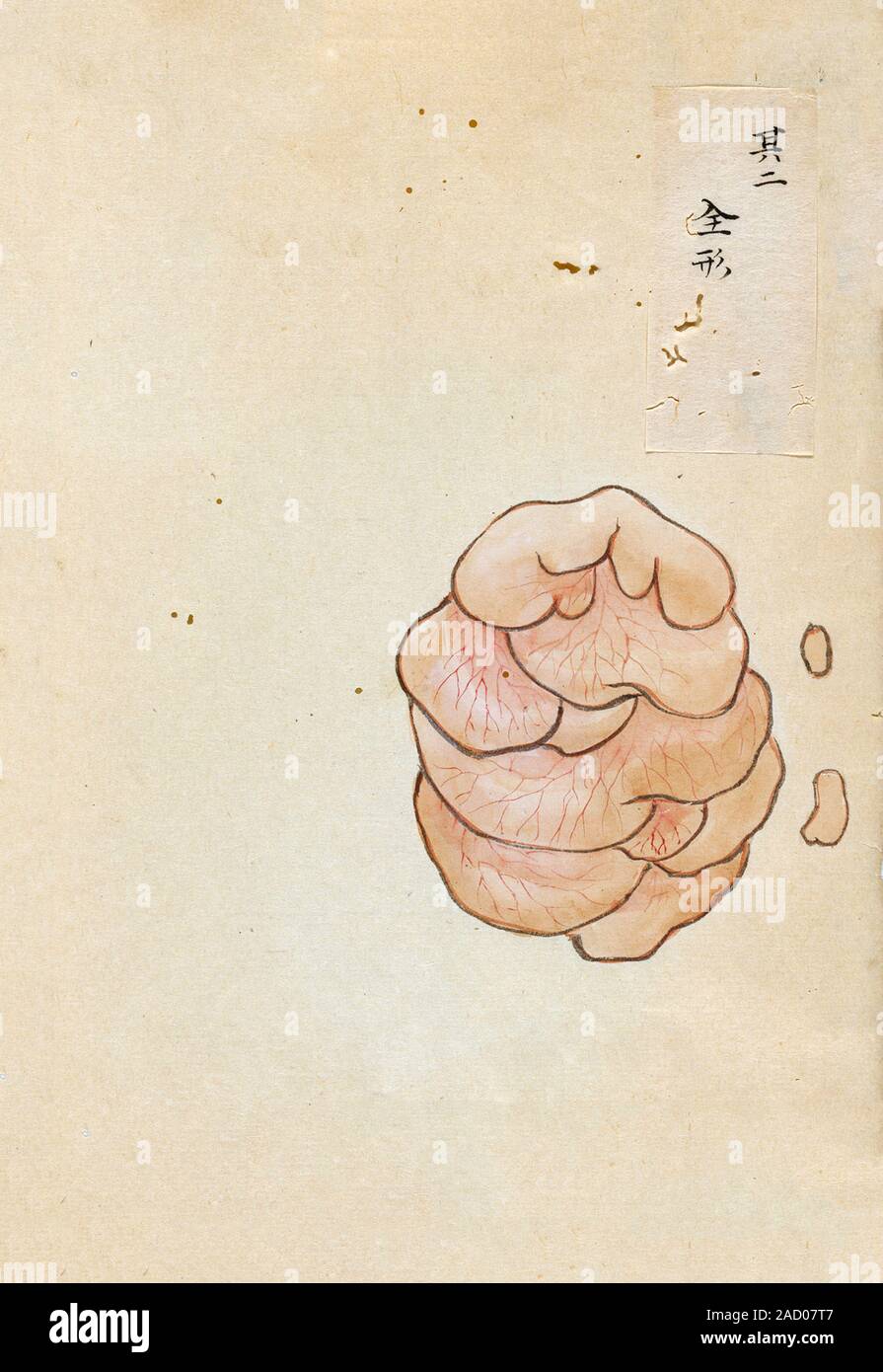 Excised tumour, 19th-century Japan. Illustration from 'A Surgical ...