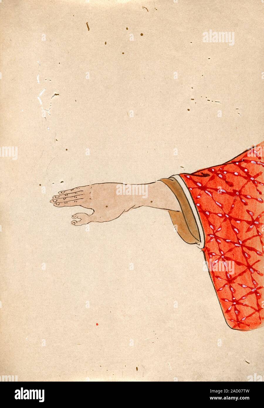 Thumb polydactyly, 19th-century Japan. Illustration of a case of ...