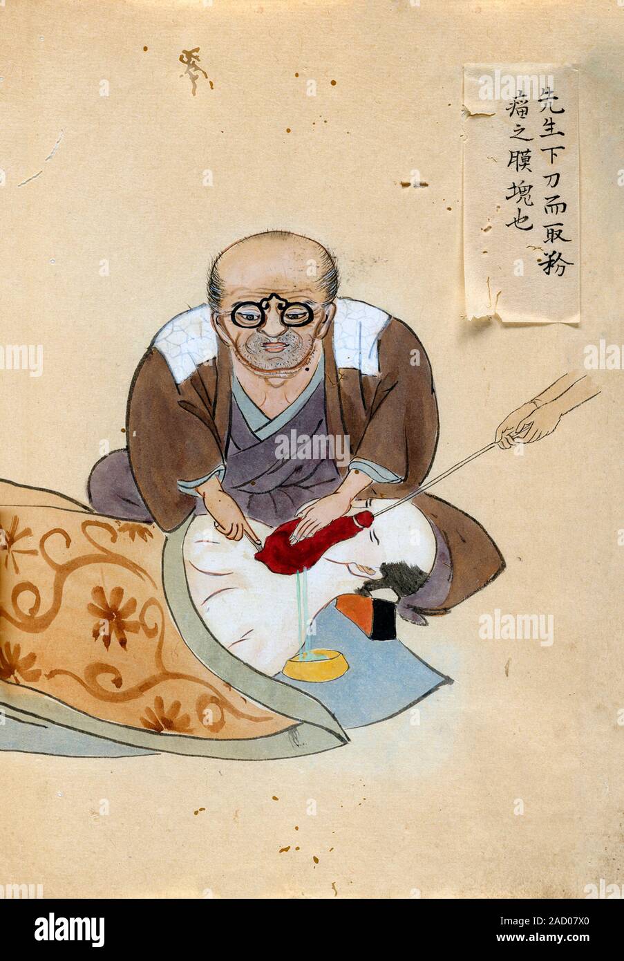 Hanaoka Seishu (1760-1835), Japanese cancer surgeon, carrying out ...