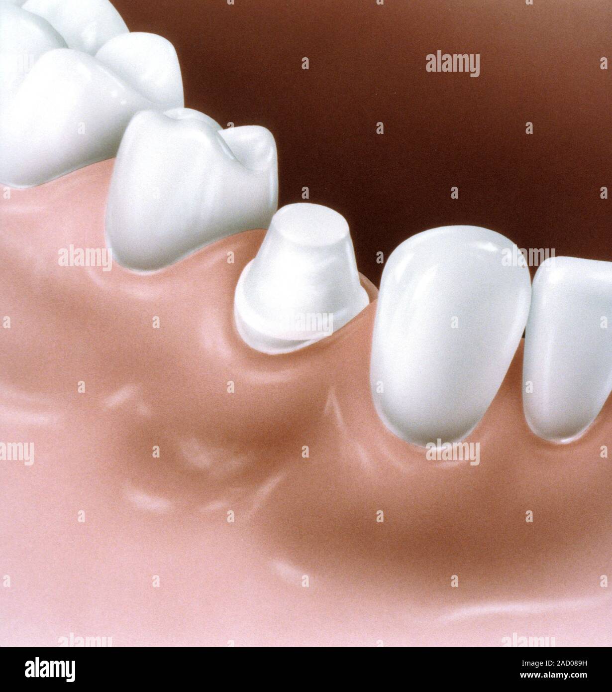 Illustration of a premolar tooth prepared by a dentist for the fitting ...