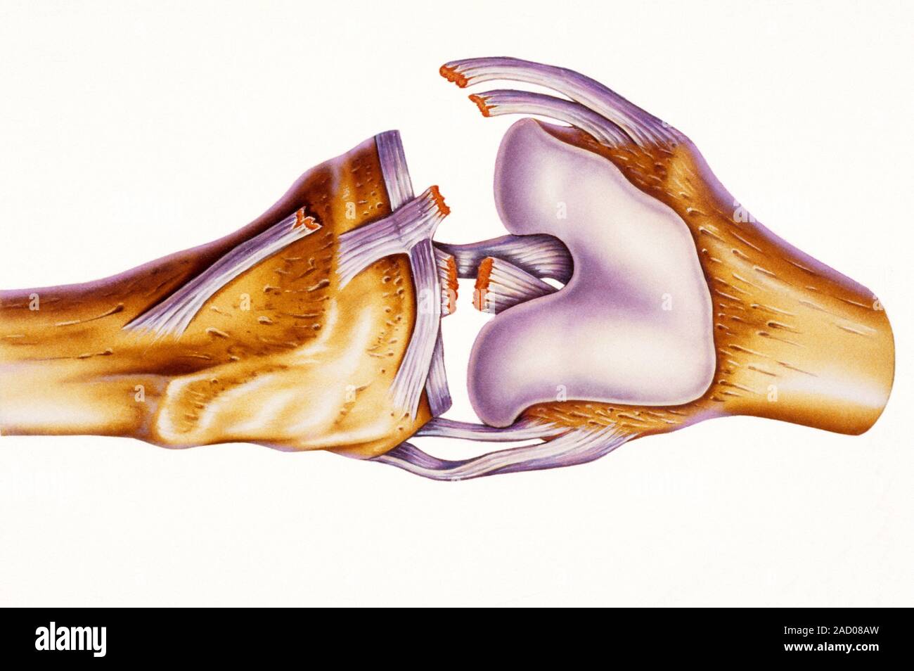 Ruptured ligaments in a knee joint. This is a frontal view of the left ...