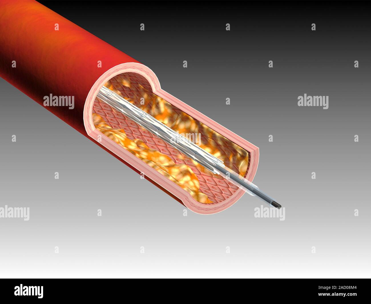 Angioplasty. Computer illustration showing coronary angioplasty. A ...