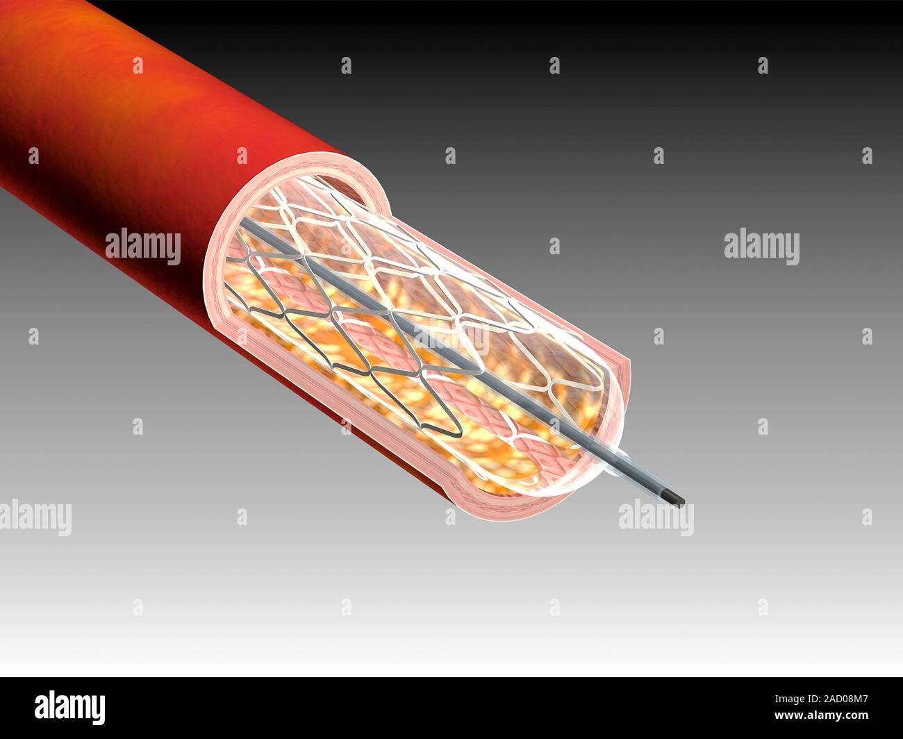 Angioplasty. Computer illustration showing a stent (wire mesh ...