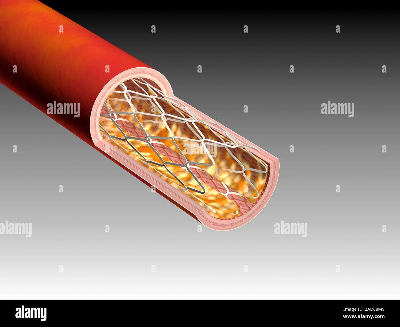 Arterial stent. Computer illustration showing a stent (wire mesh ...