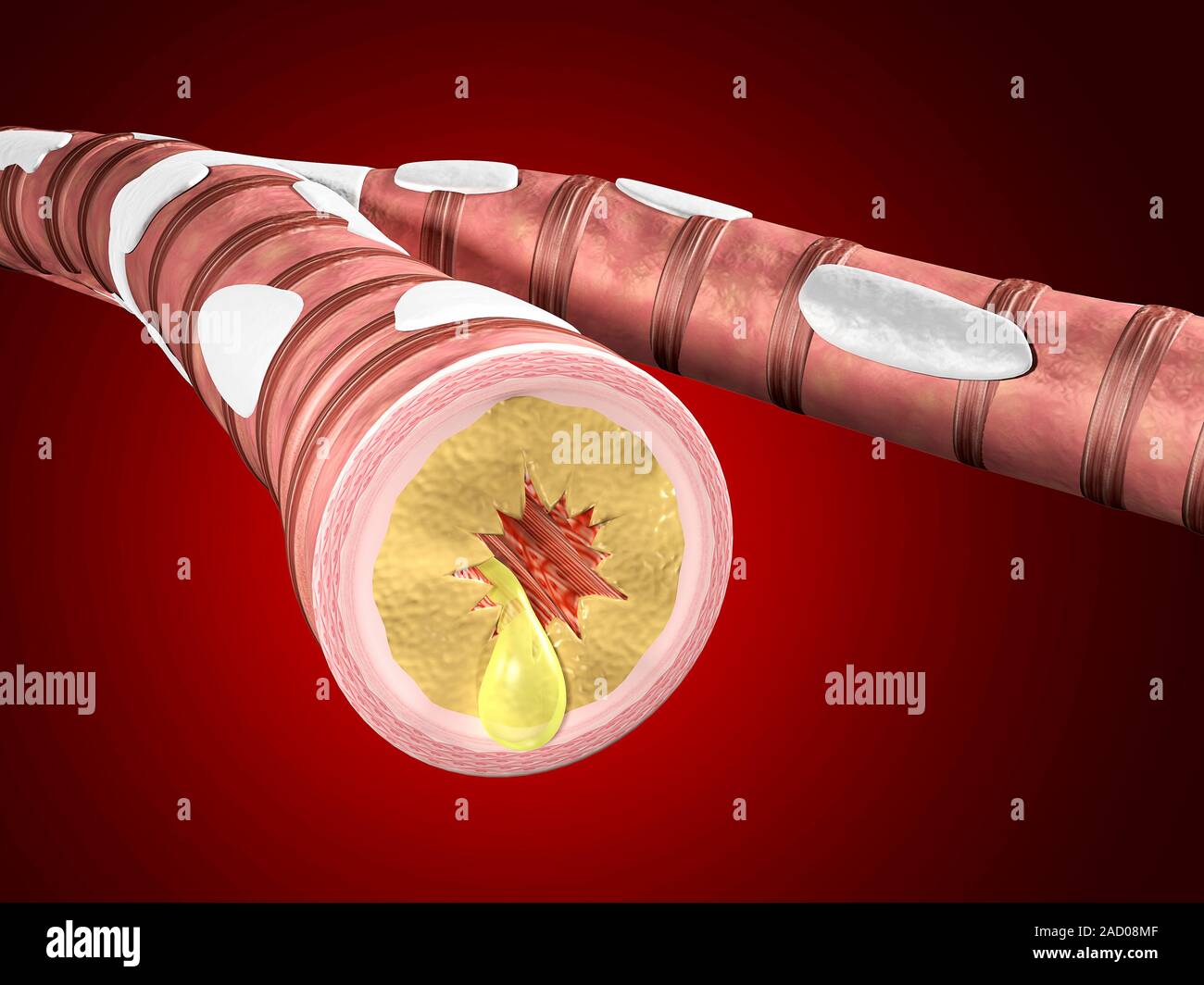 Bronchitis, illustration. A sectioned bronchus with excess mucus ...