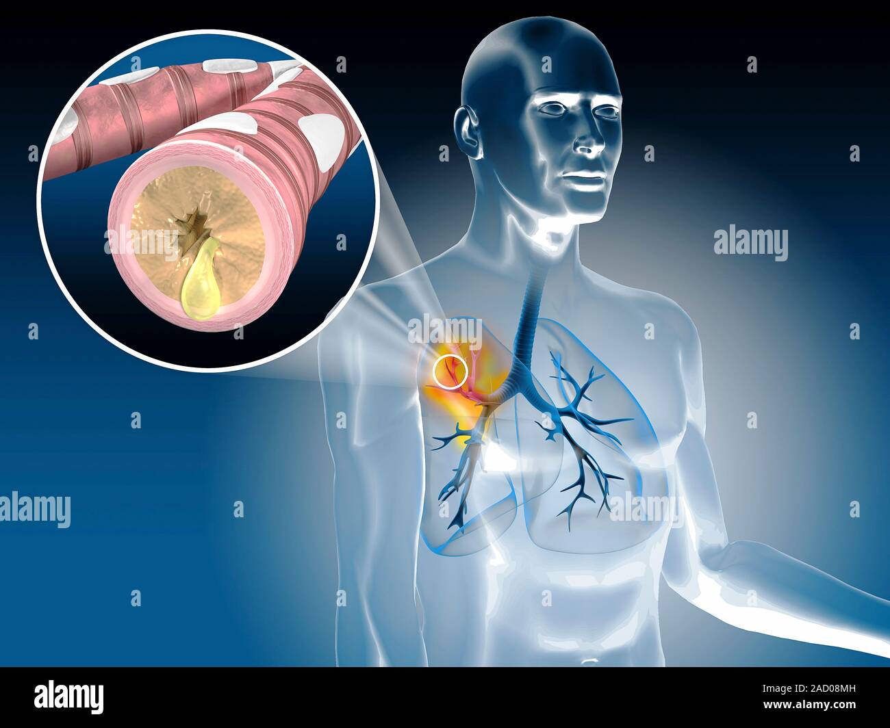 Bronchitis, illustration. A sectioned bronchus with excess mucus ...