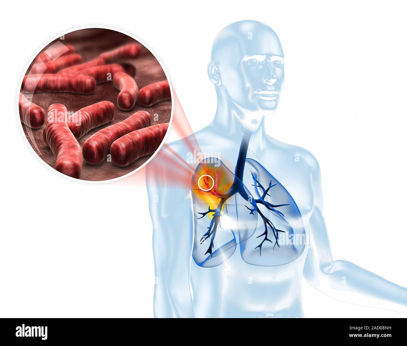 Tuberculosis infection. Illustration of Mycobacterium tuberculosis ...