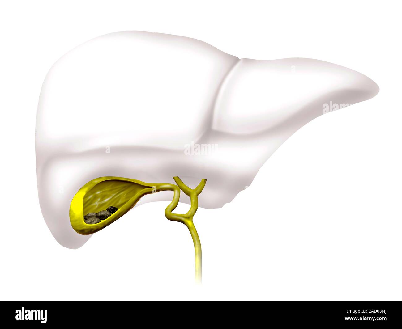 Gallstones. Cutaway computer illustration showing gallstones (black) in ...
