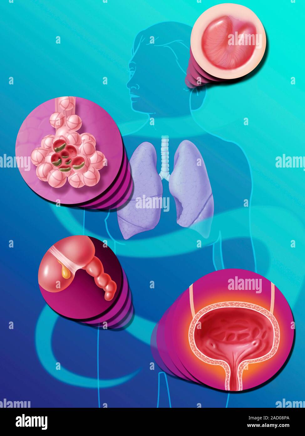 Septic shock. Illustration showing areas where untreated infection can ...
