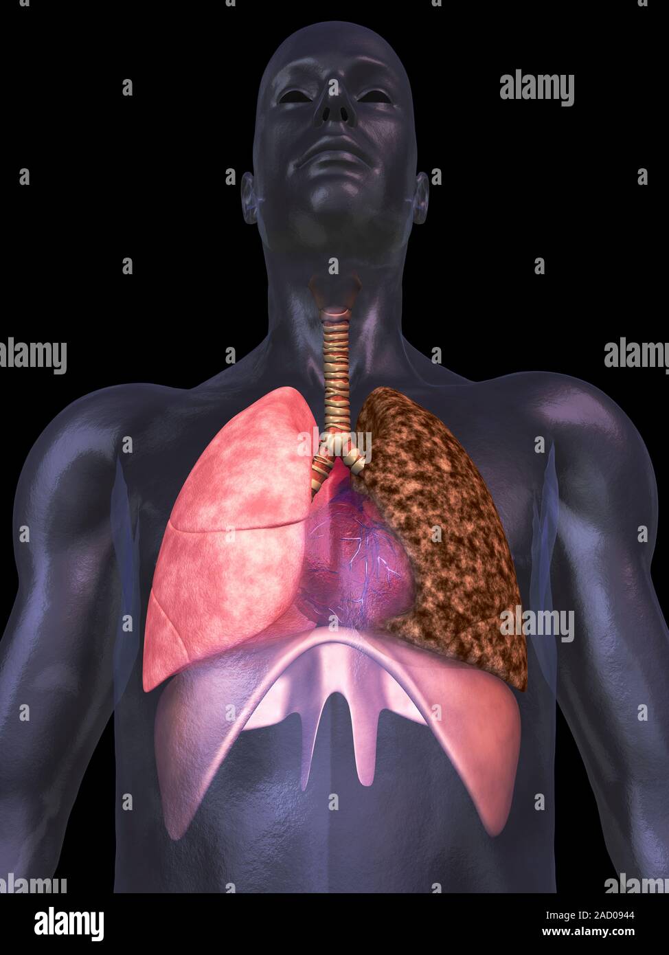 The effects on smoking on lung tissue . Computer illustration of the ...