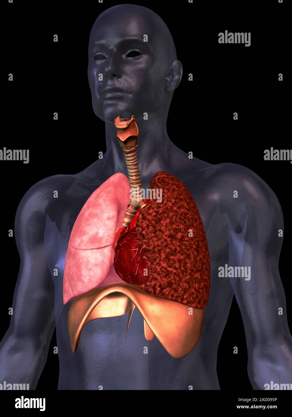 The effects on smoking on lung tissue . Computer illustration of the ...