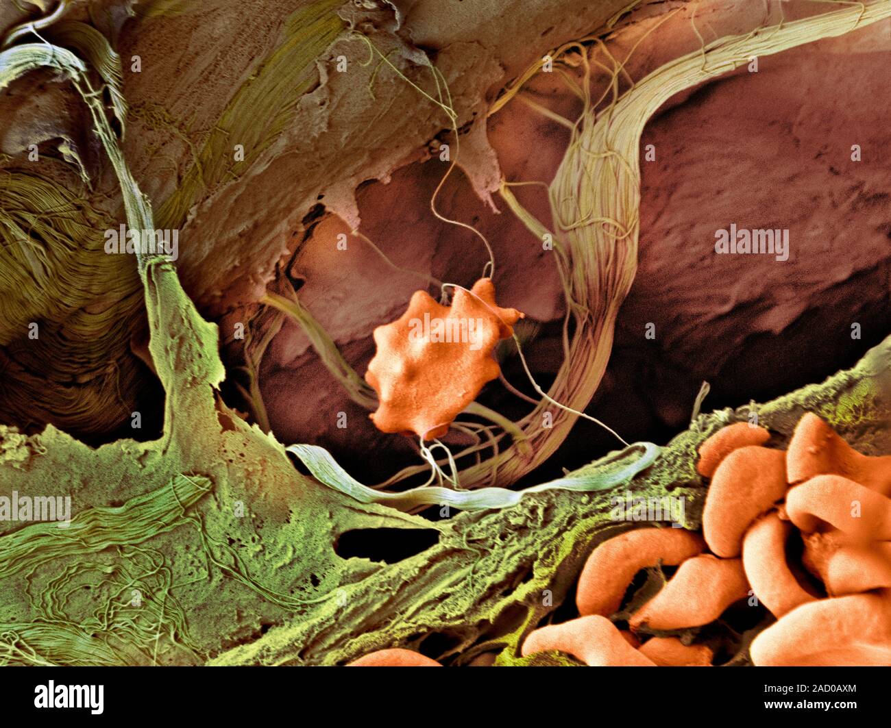 Crenated red blood cell. Coloured scanning electron micrograph (SEM) of ...