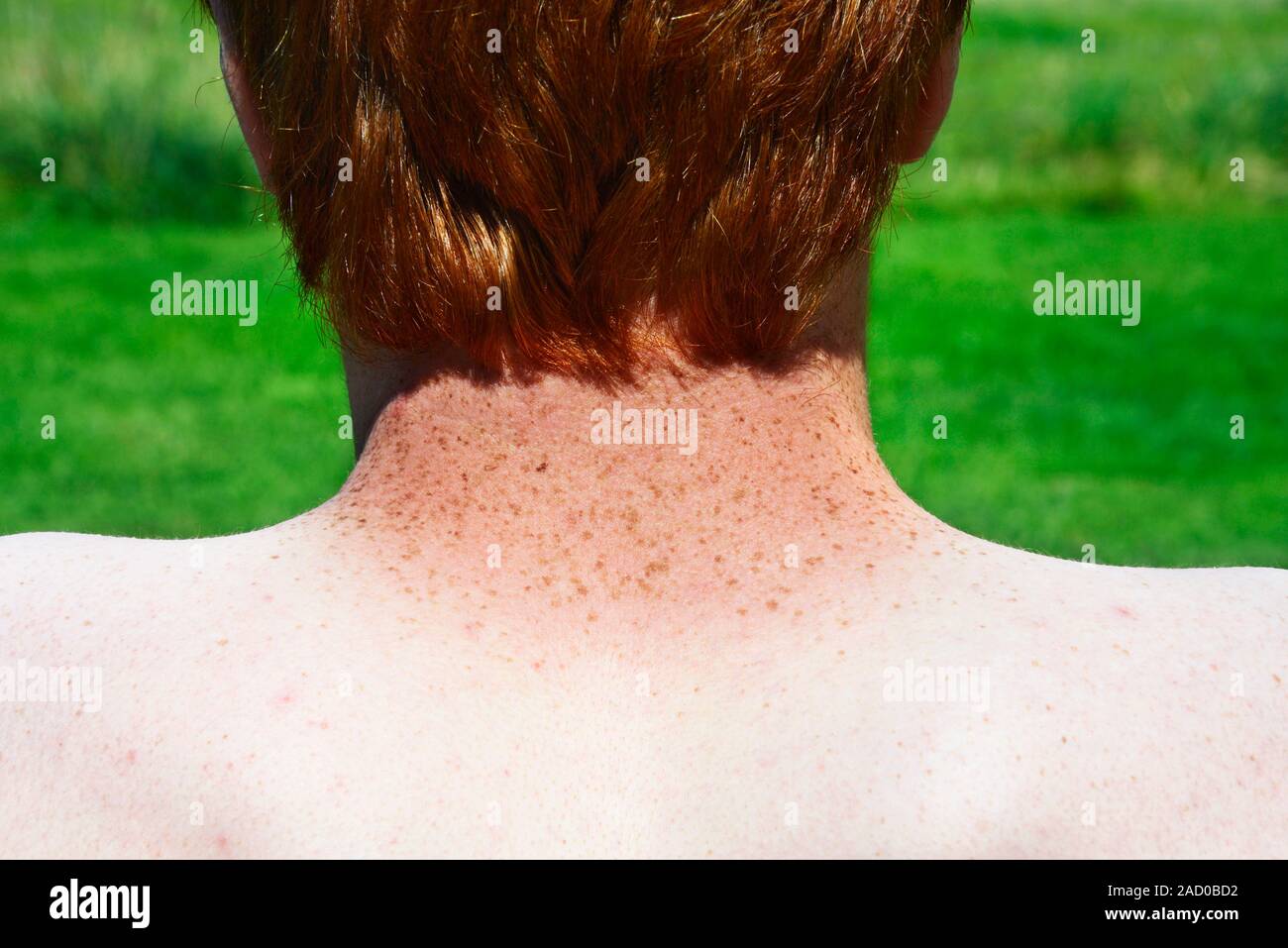Sun-tanned freckled neck. Rear view of the neck and shoulders of an 18 ...