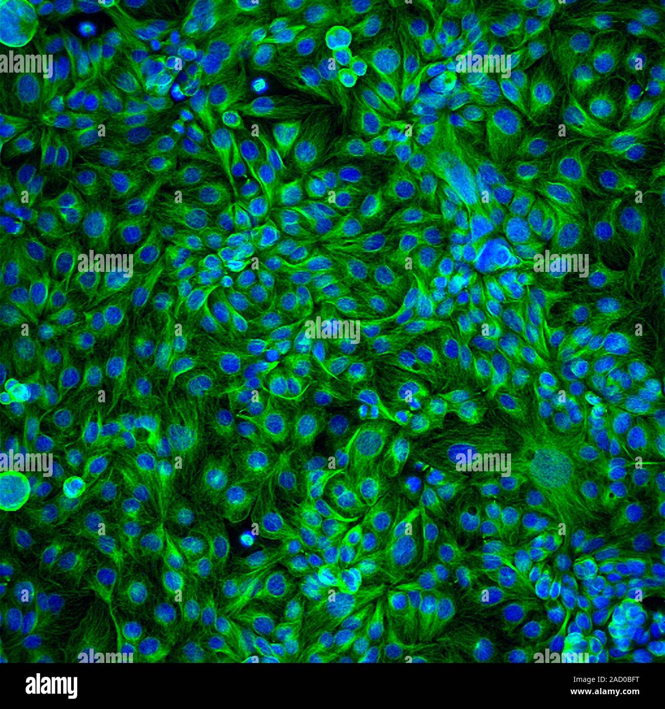 Colon cancer cells, confocal fluorescence light micrograph. These are ...