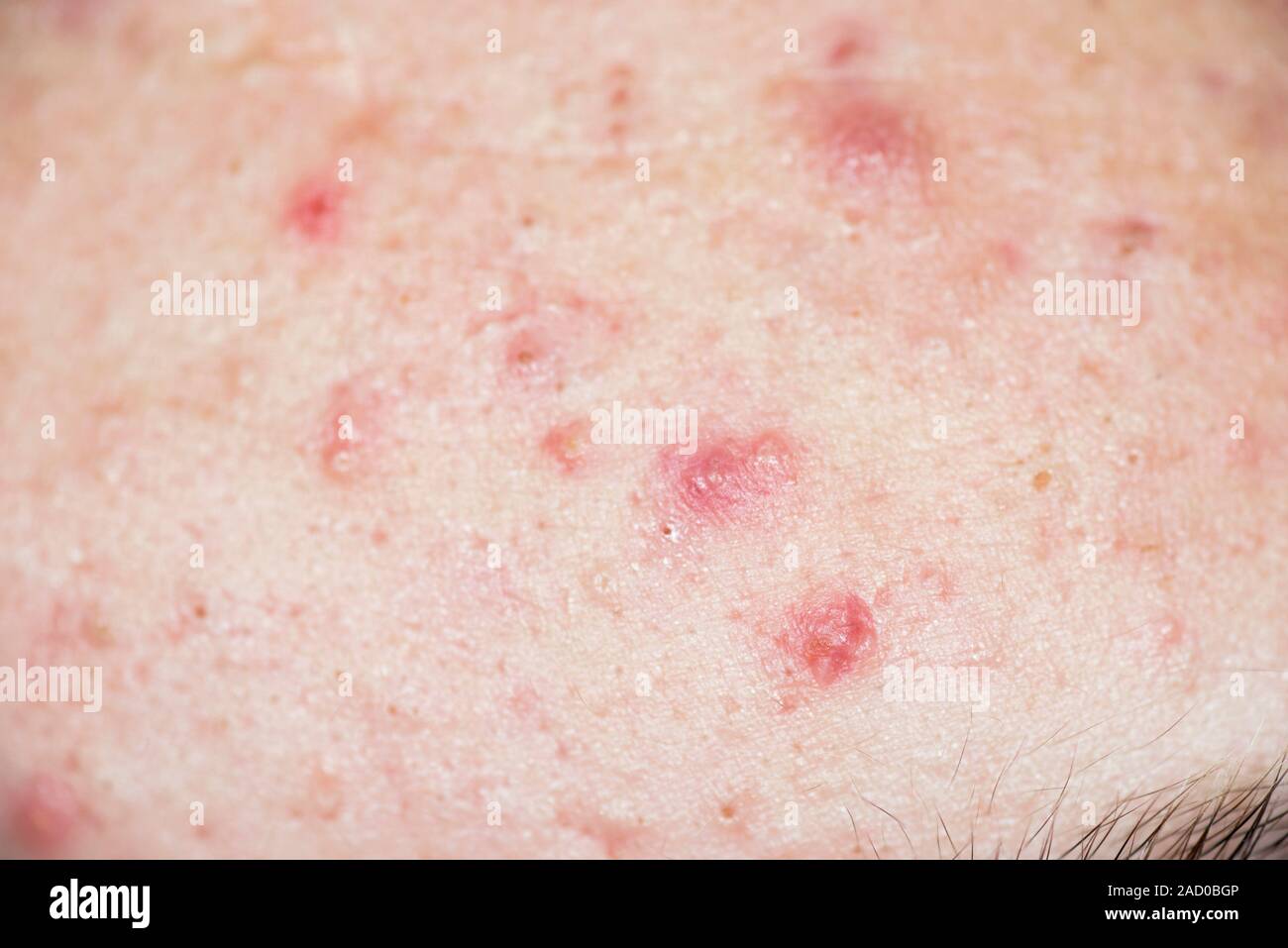 Acne. Close-up of the forehead of an 18-year-old male patient with acne ...