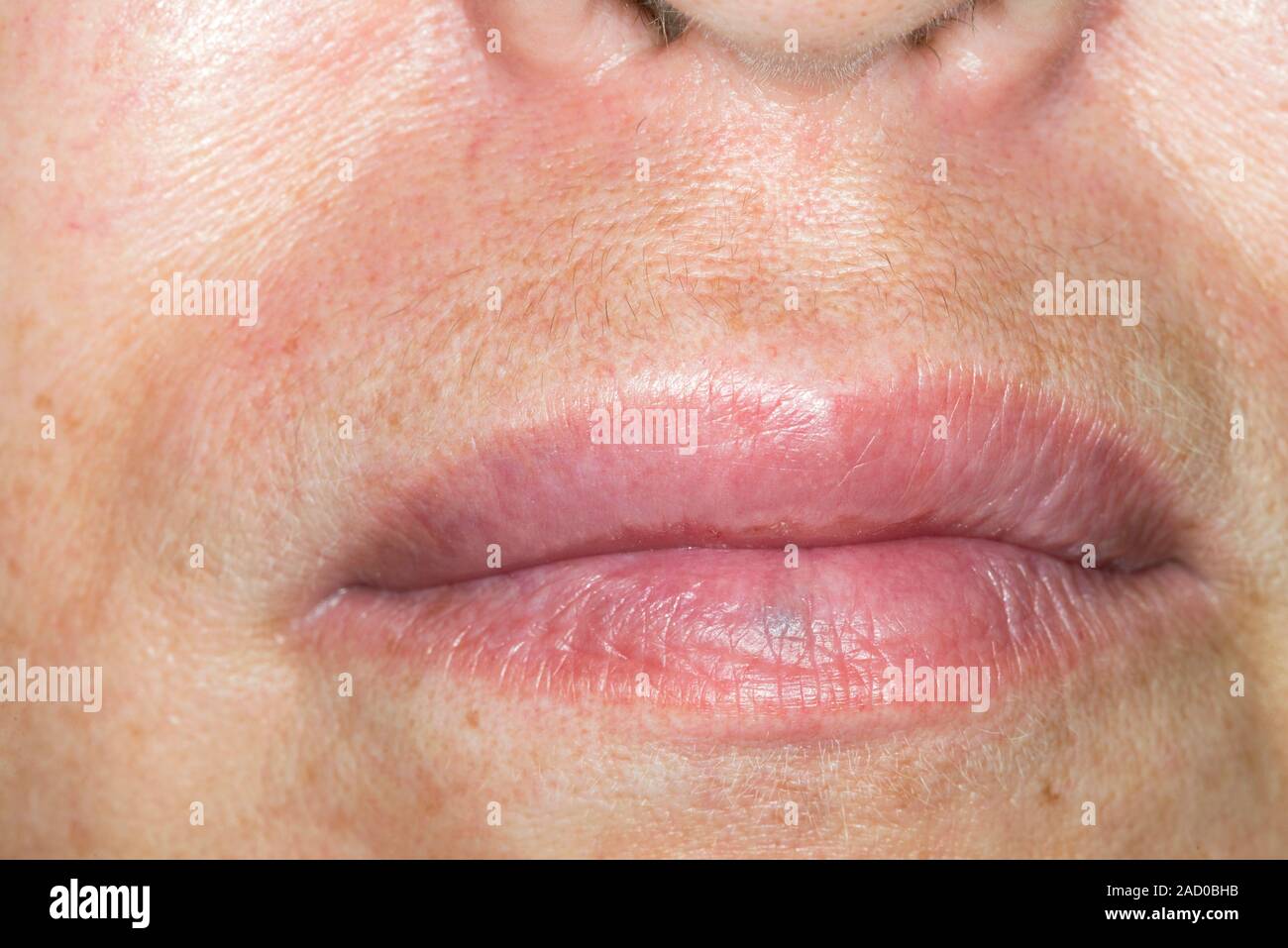 Swollen lips. Close-up of the face of a 57-year-old female patient with ...