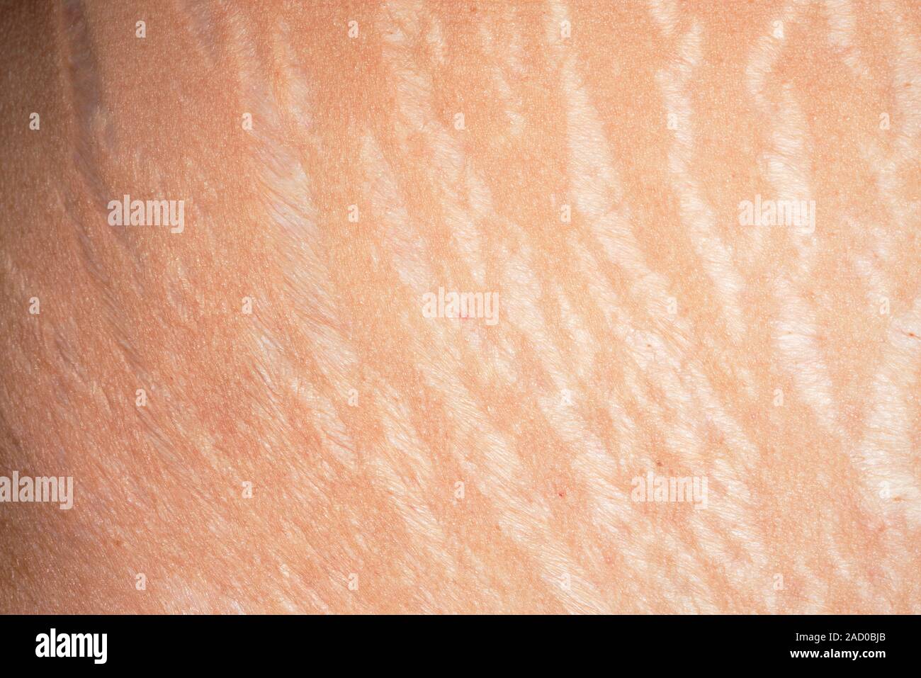 Stretch marks. Close-up of stretch marks (striae) on the abdomen of a ...