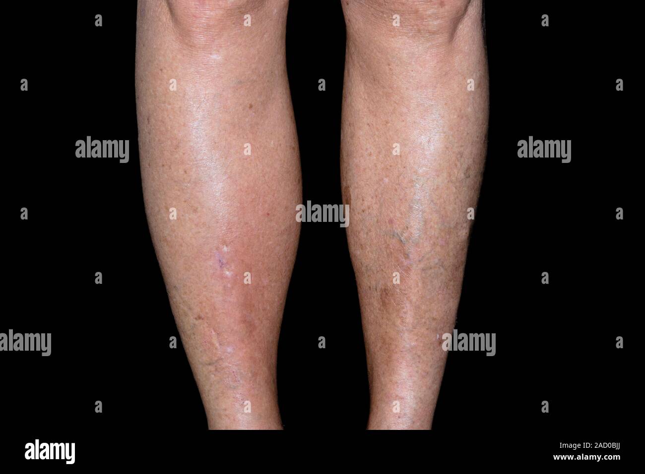 Post-thrombotic syndrome. Close-up of red and inflamed skin on the legs ...