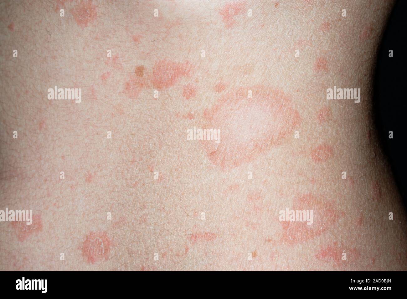 Pityriasis rosea. Close-up of a rash on the abdomen of an 20-year-old female patient with ...