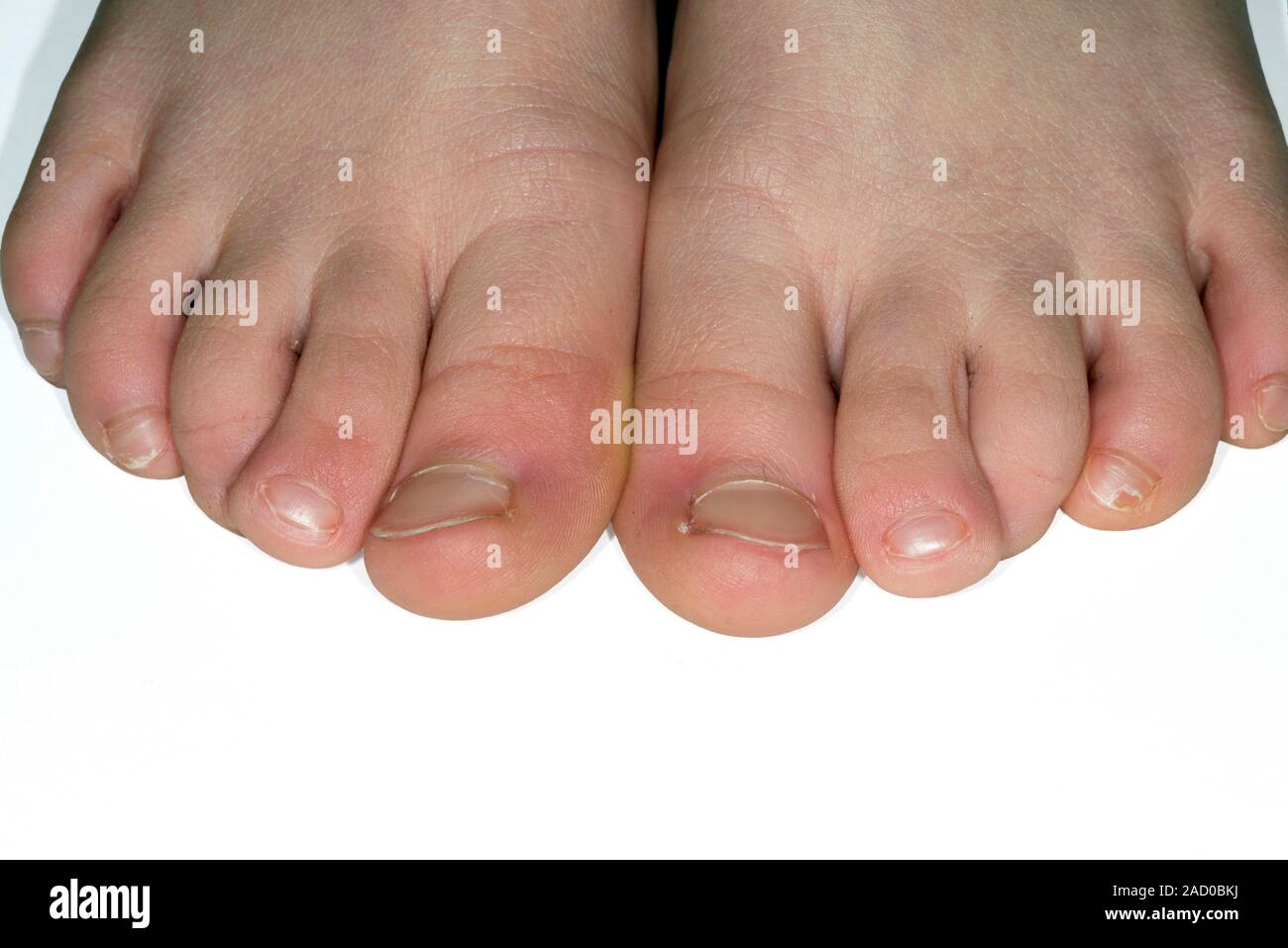 Overriding toes. Close-up of the feet of a 5-year-old female patient ...